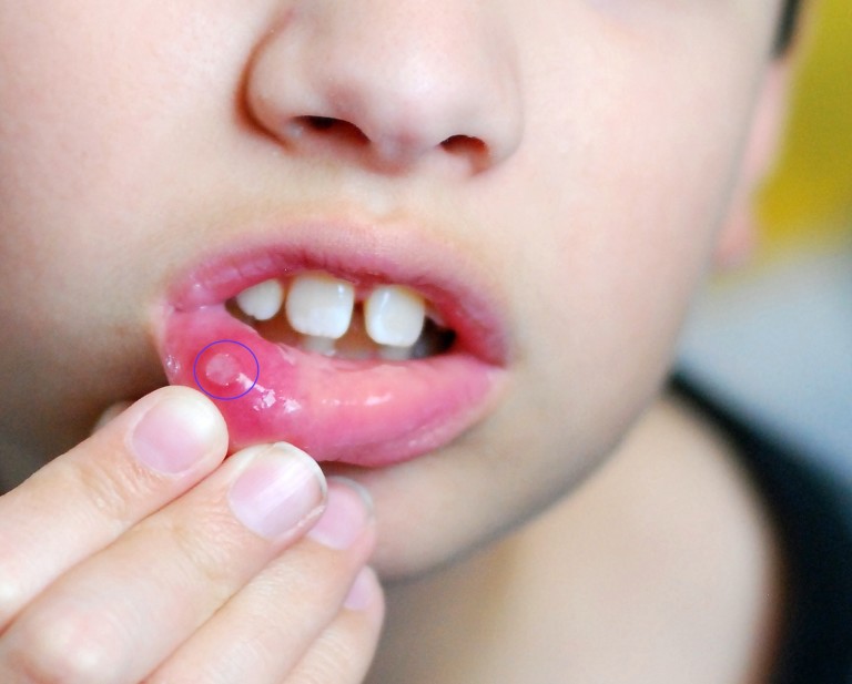 Stomatitis in children: domiciliary treatment - Top Wellness Life